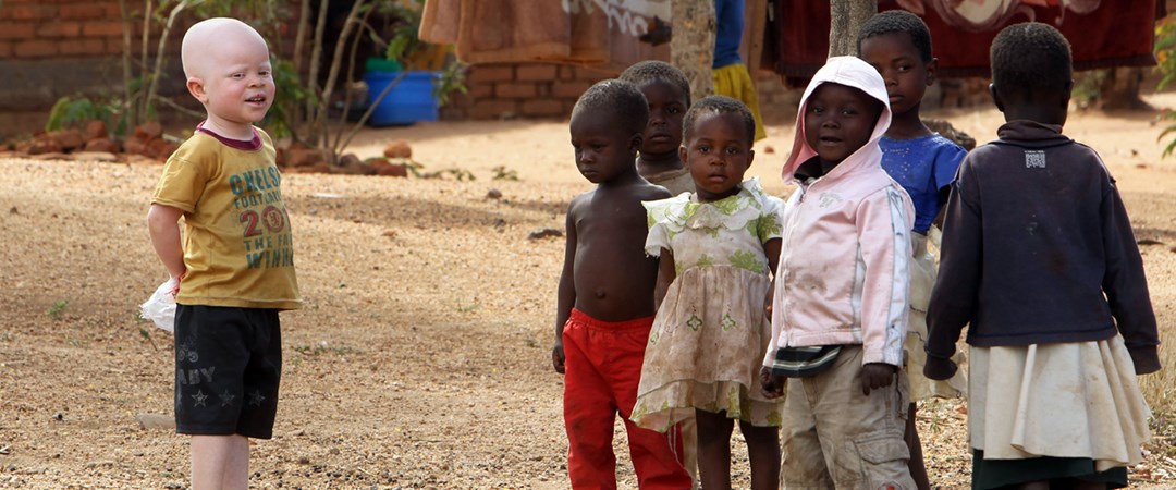 Afrika'nın dışlanan insanları: Albinolar (13 Haziran Dünya Albinizm ...