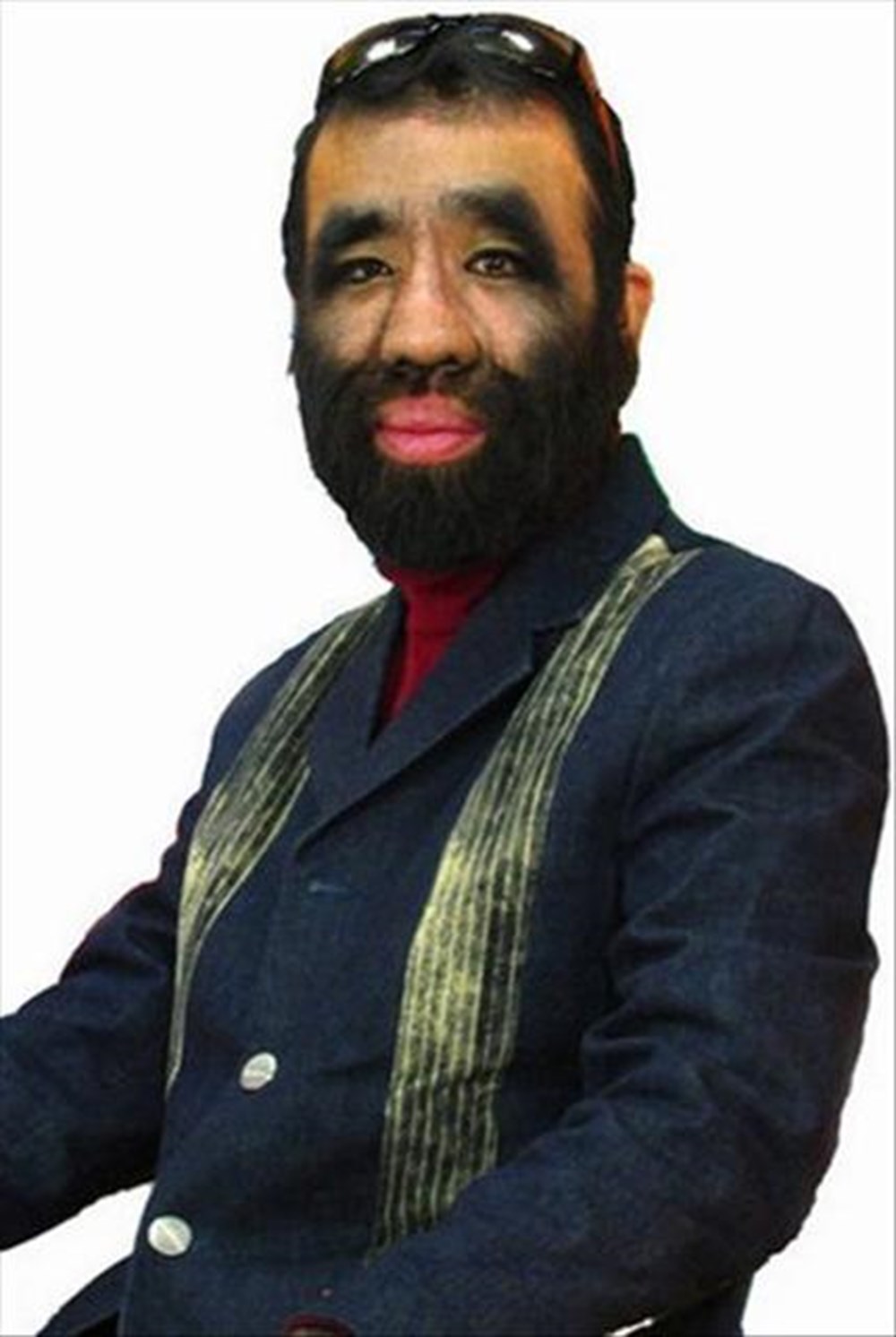 ‘Maymun adam’a estetik - Son Dakika Yaşam Haberleri | NTV Haber