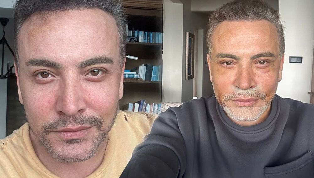Estetik operasyon geçiren Cenk Eren: Nazar değdirdiniz - Son Dakika ...