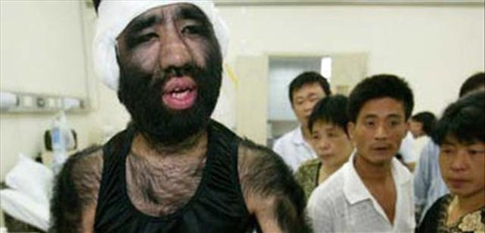 ‘Maymun adam’a estetik - Son Dakika Yaşam Haberleri | NTV Haber