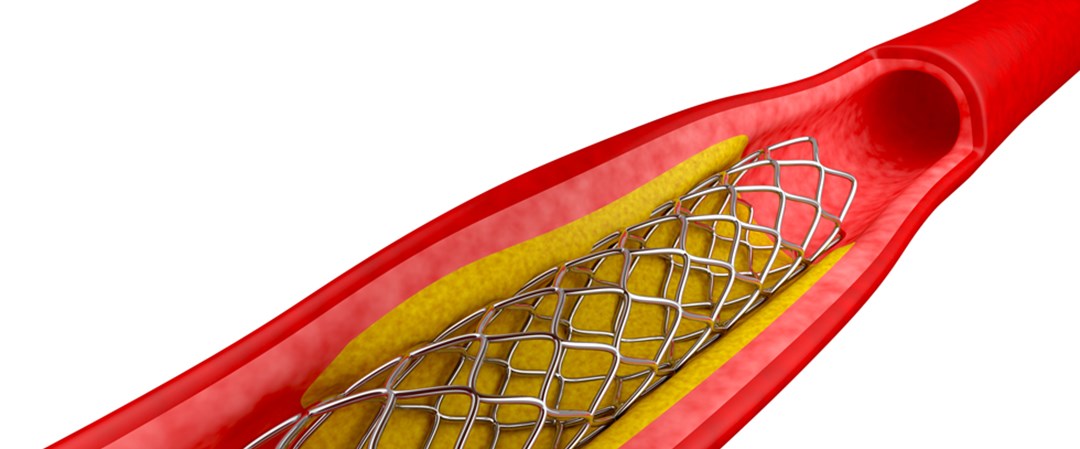 Yeni stent teknolojisi, kalp hastalarına avantaj sağlıyor - Sağlık ...