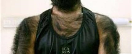 ‘Maymun adam’a estetik - 1 | NTV