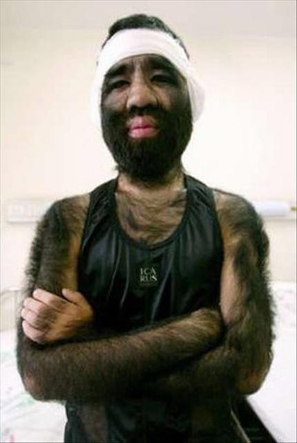 ‘Maymun adam’a estetik - 1 | NTV